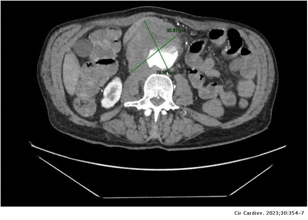 Aortoenteric fistula: Endovascular aortic aneurysm repair - Cardiology ...